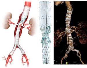 Endovaskuläre Aortenbehandlung